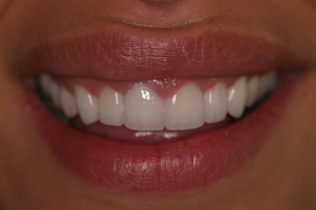 Case 1 Gum Reshaping Surgery Before And After Gallery