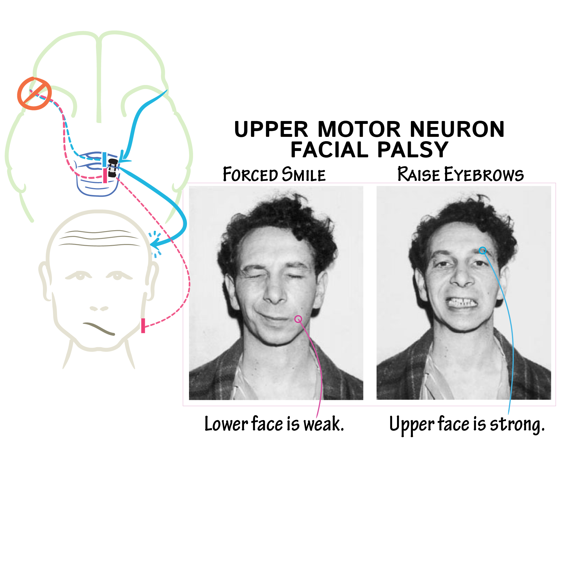 Clinical Pathology Glossary Facial Palsy Bells Palsy Ditki