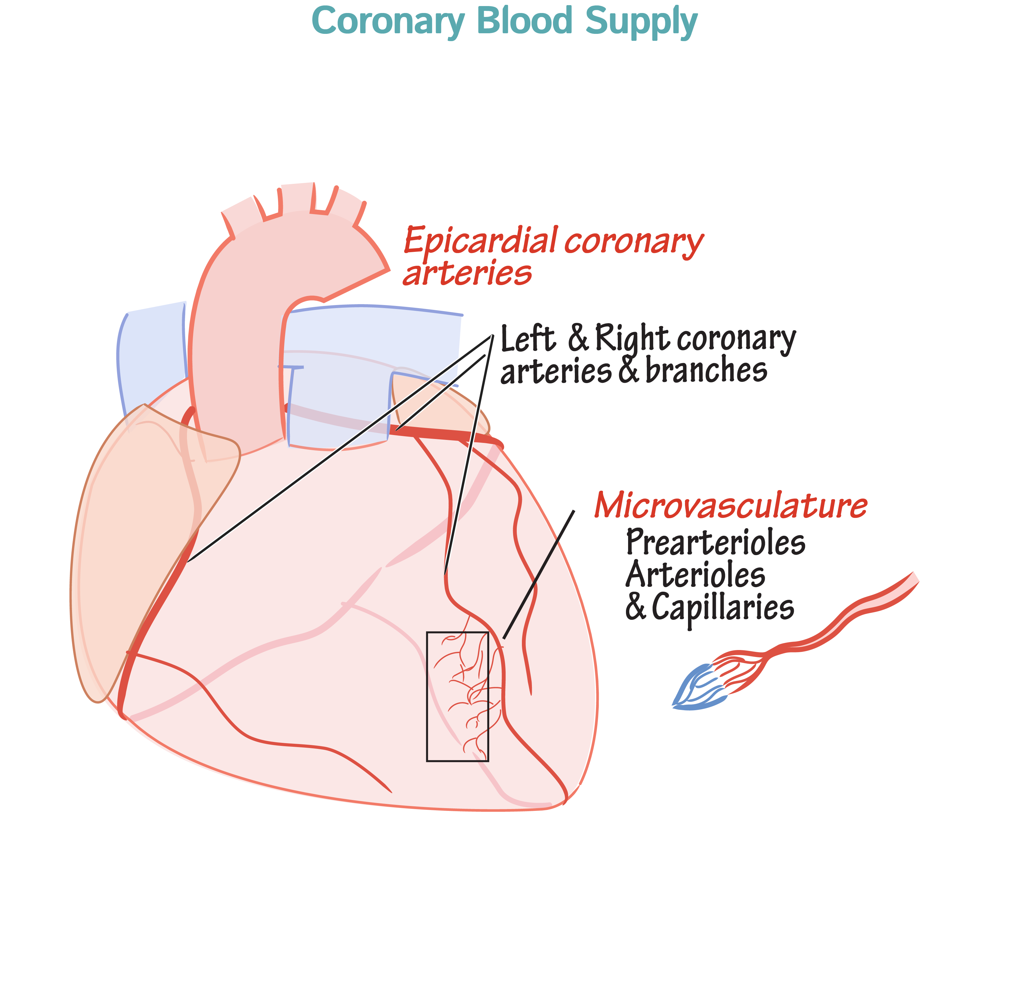 Pathology Glossary Ischemic Heart Disease Draw It To Know It