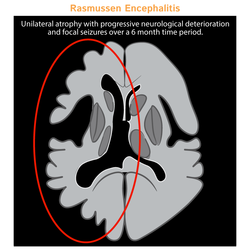 Neurological System Glossary Rasmussen Encephalitis Draw It To Know It