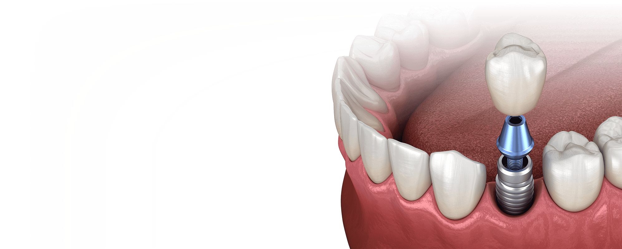 Dental Implant Cost Troy Mi Birmingham Mi Bloomfield Mi