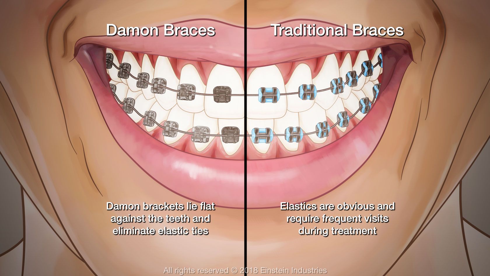 Damon™ Braces