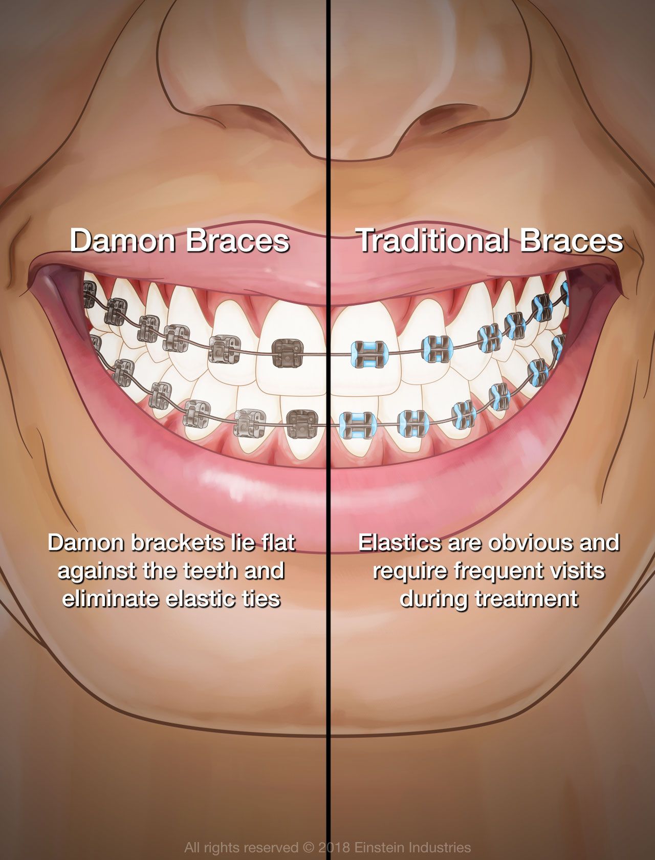 Damon Clear Braces Vs Ceramic Braces