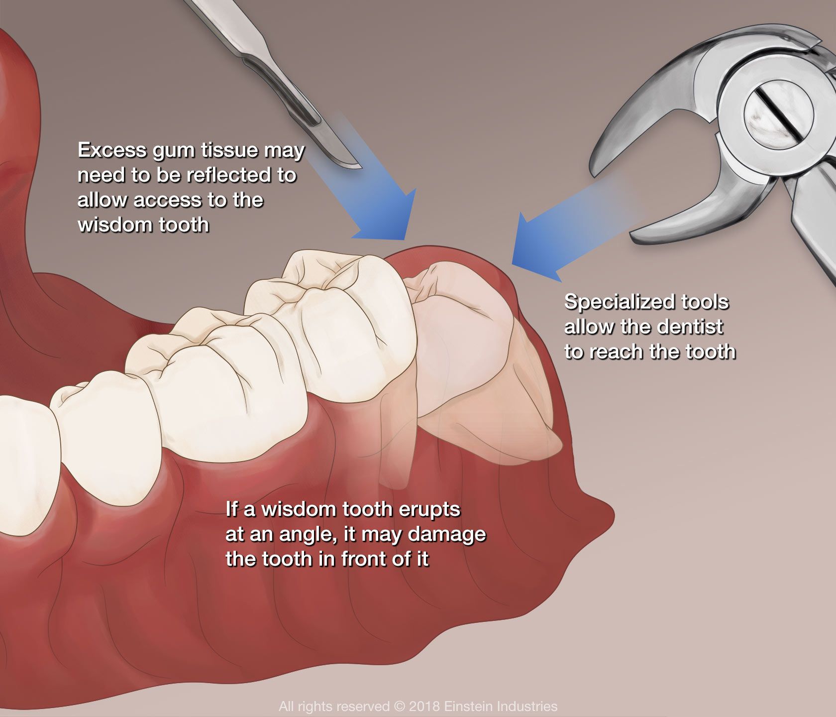 Wisdom Teeth Removal And Oral Surgery In Richmond Tx Best Dental