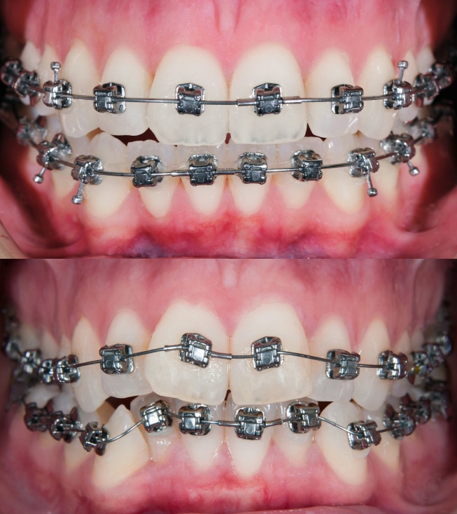 Braces Progress 2 Weeks At Victor Pagan Blog