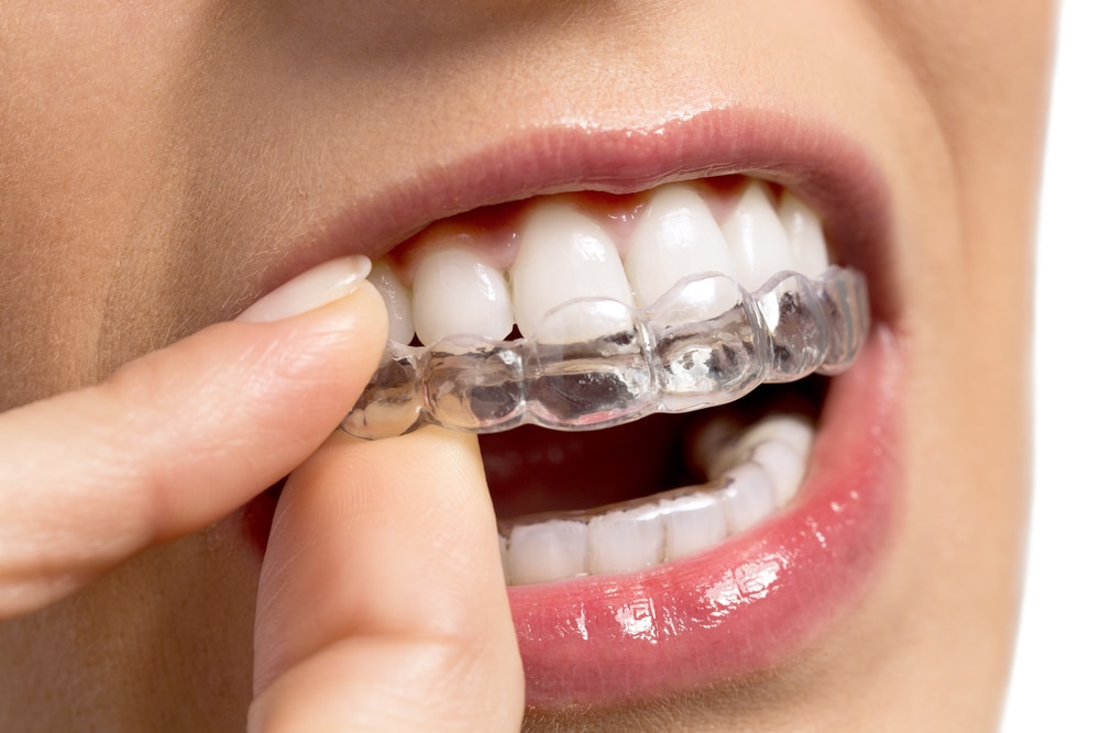 Invisalign® Orthodontic Associates