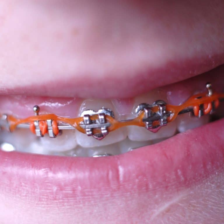 Braces And Power Chains Orthodontic Associates