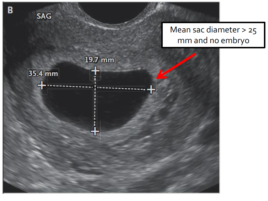 Non Viable Pregnancy Meaning Pregnancywalls