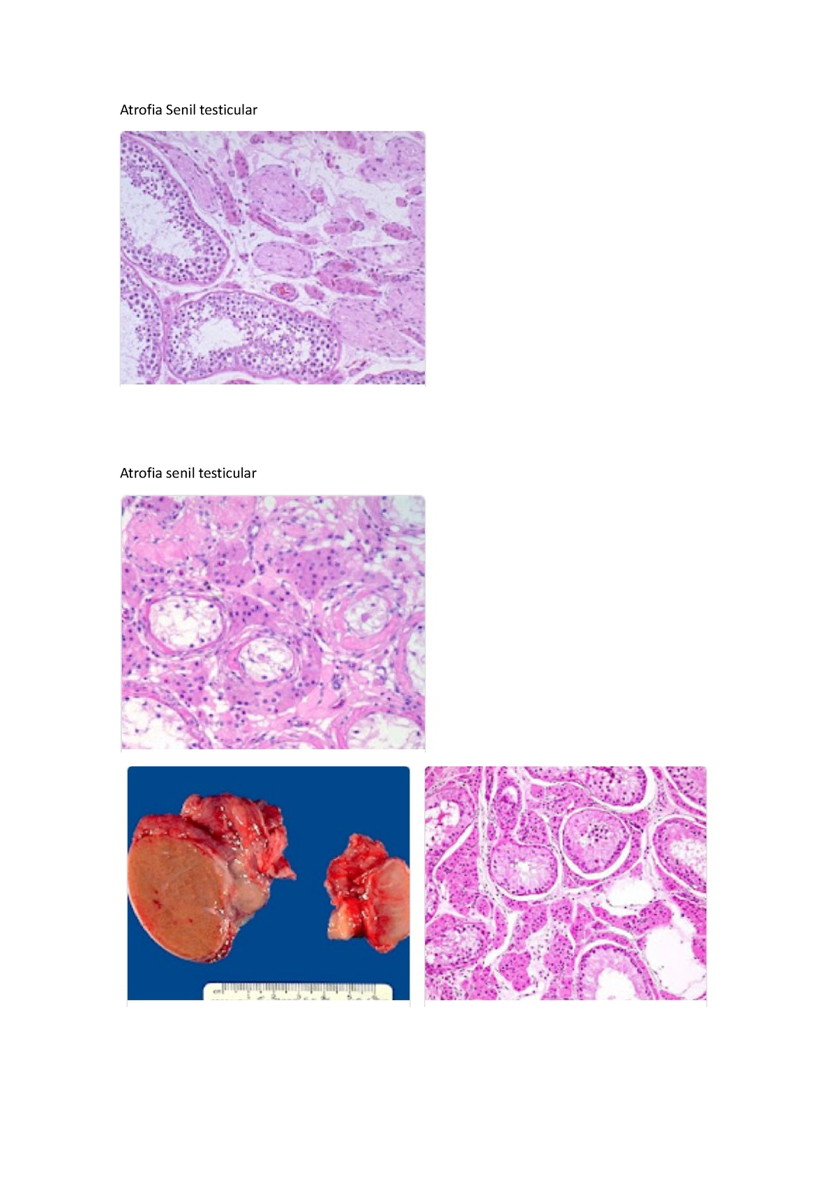 Atrofia Senil Testicular Atrofia Senil Testicular Atrofia Senil