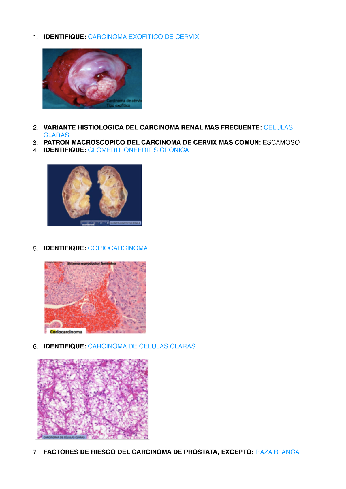 Examen Final De Anatomia Patologica Ii 1 Identifique Carcinoma