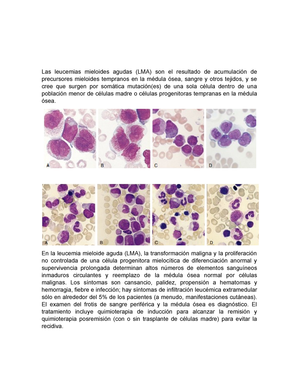 Leucemia Mieloide Aguda Las Leucemias Mieloides Agudas Lma Son El