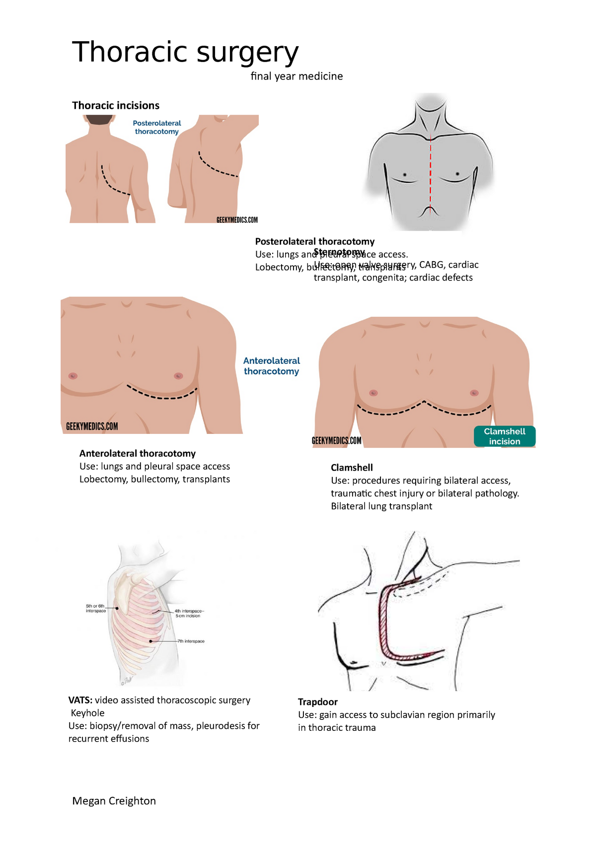 Thoracic Surgery Final Year Medicine Thoracic Incisions