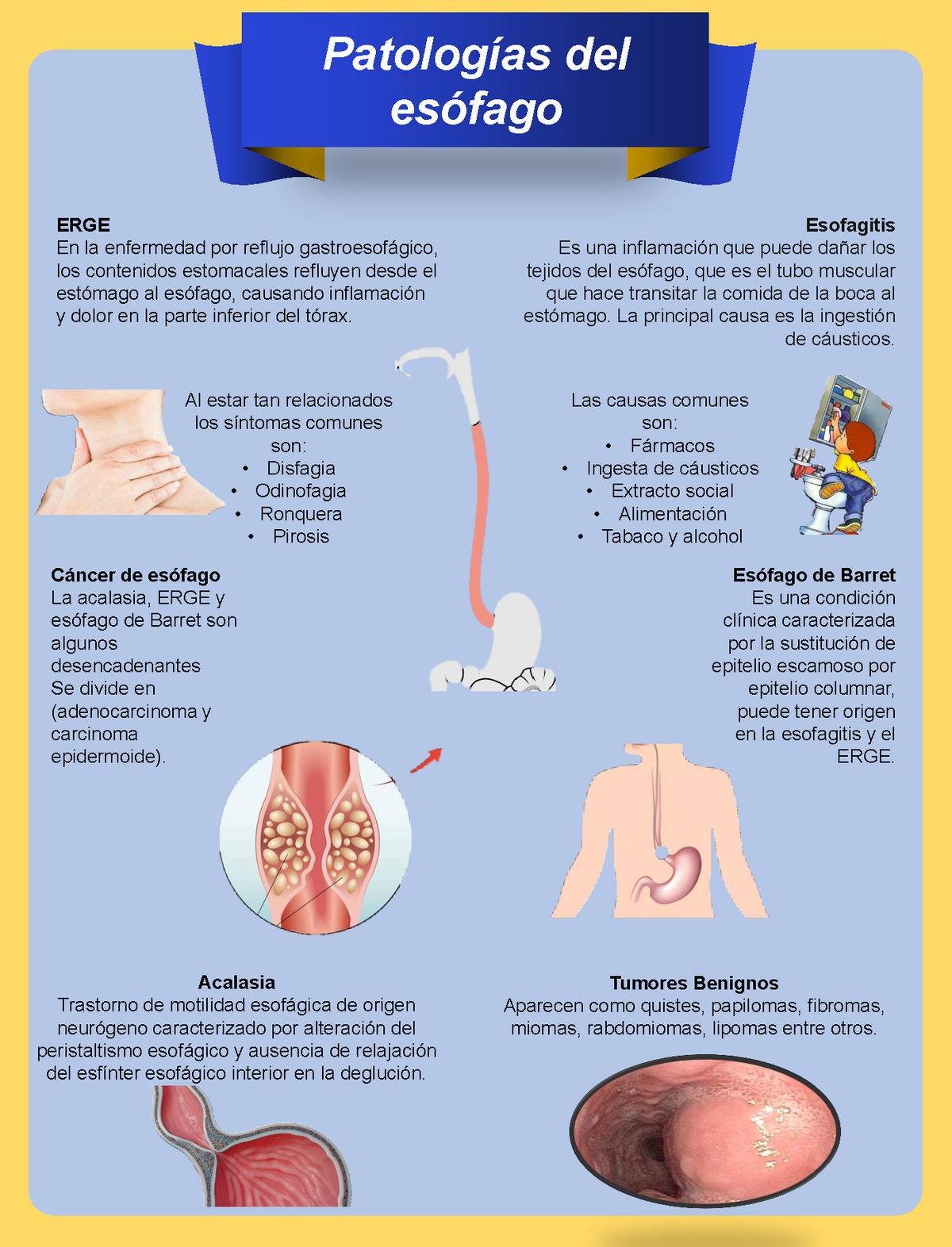 Infografia Esofago Infografía Del Esófago Patologías Del Esófago