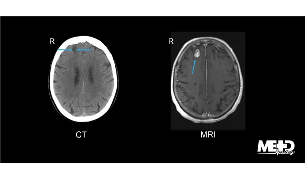 Cat Scan Brain Tumor