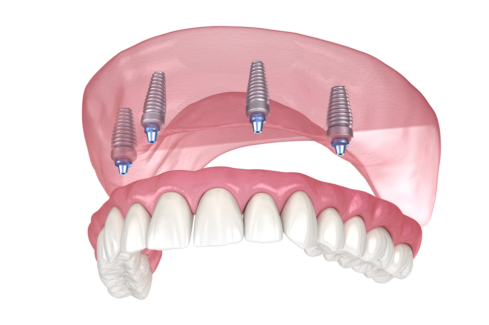 Implant Supported Dentures Palm Beach Fl Palm Beach Periodontics