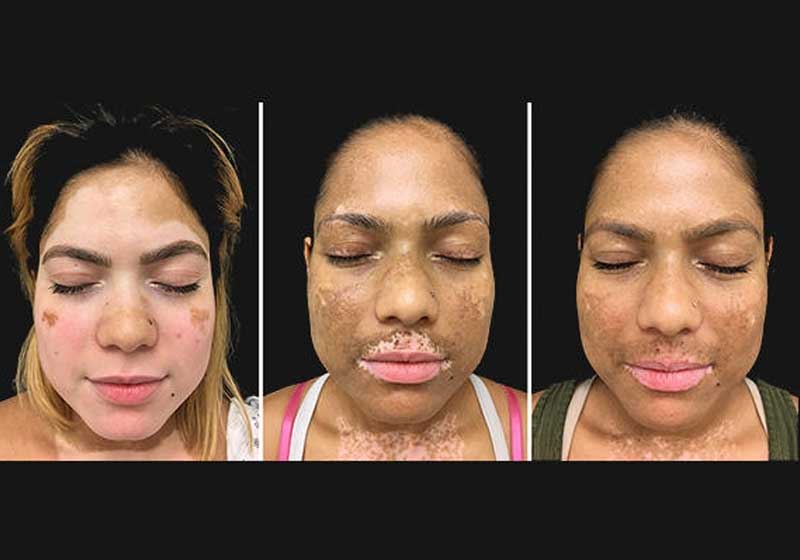 Vitiligo Terapia Inovadora Dos Eua Recupera Cor Da Pele Só Notícia Boa