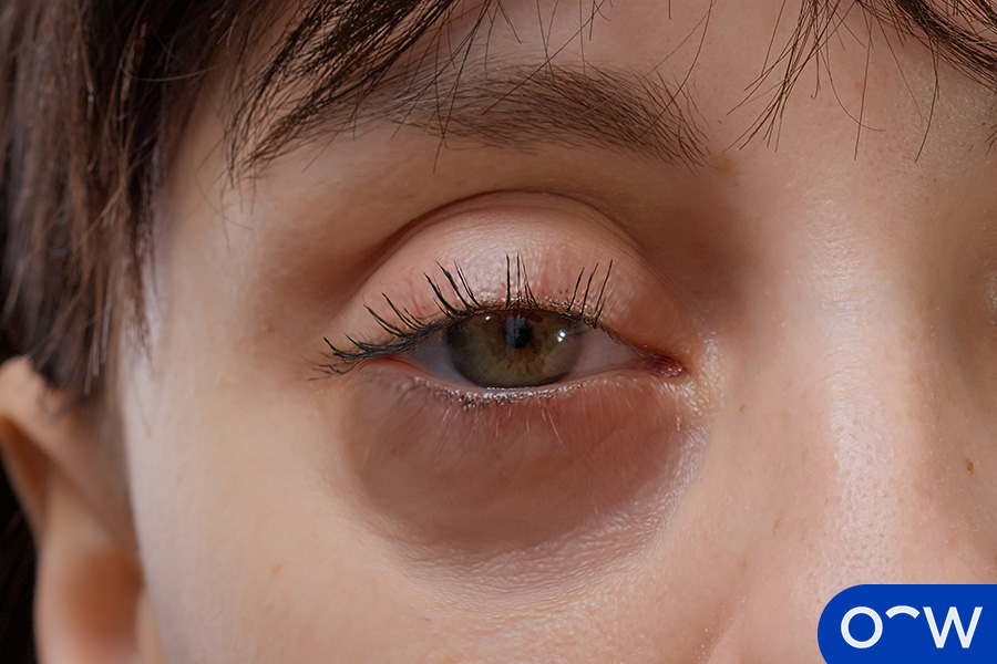 Puffy Eyes Definition Causes Symptoms And Treatment