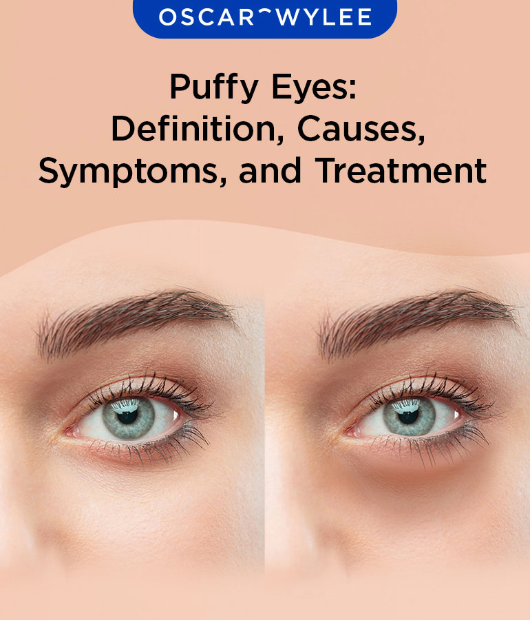 Puffy Eyes Definition Causes Symptoms And Treatment