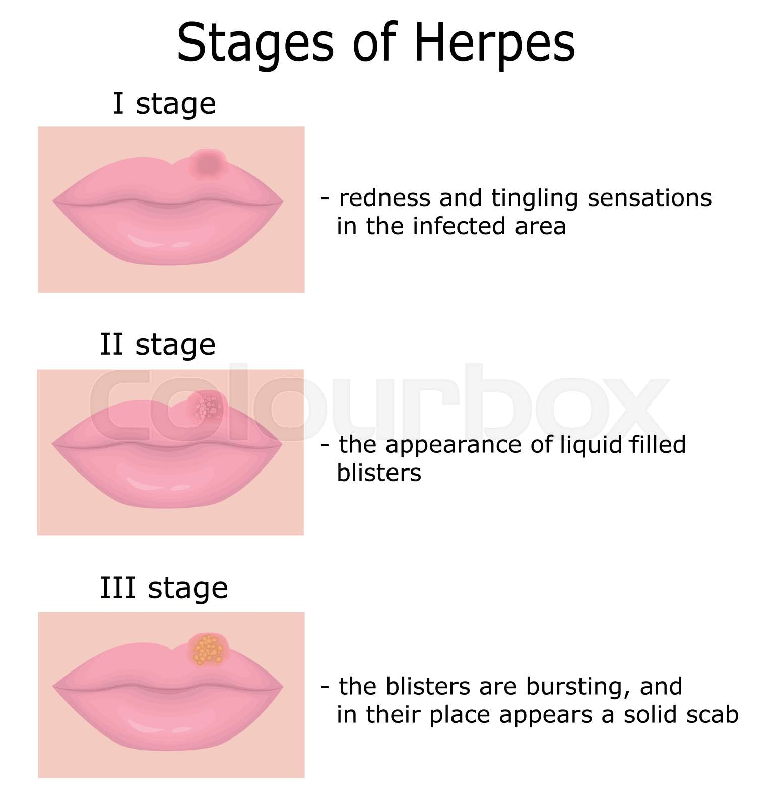 How Long Can Herpes Live On Metal At Jimmie Graham Blog