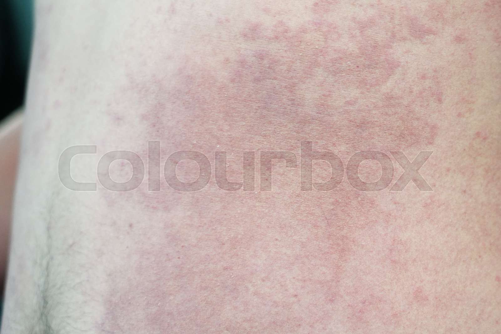 Close Up Allergy Rash On A Man Skin Stock Image Colourbox