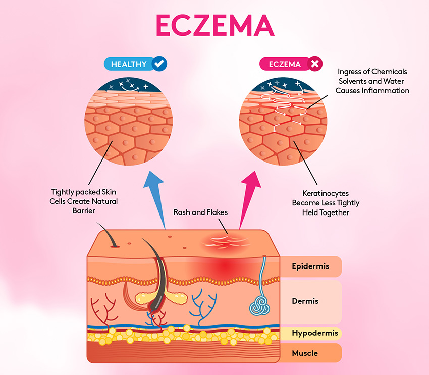 What Causes Eczema And How To Treat It Like A Derm Blog Huda Beauty