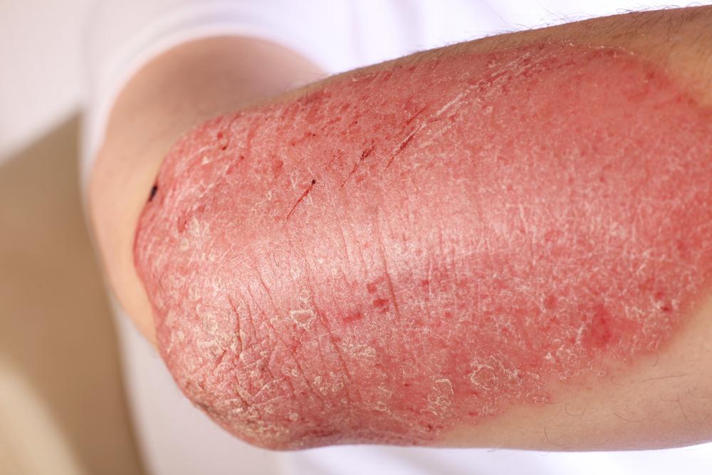 Symptoms Causes Types And Treament Of Eczema