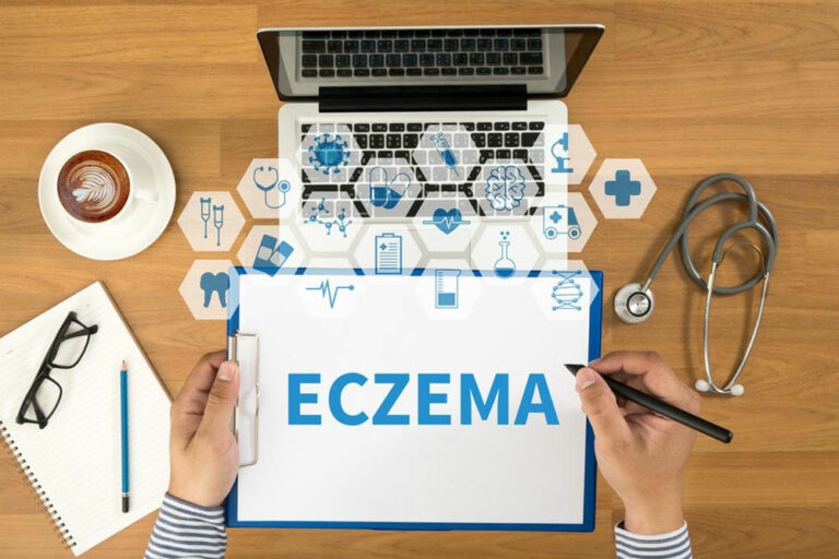 Everything You Need To Know About Eczema Discover