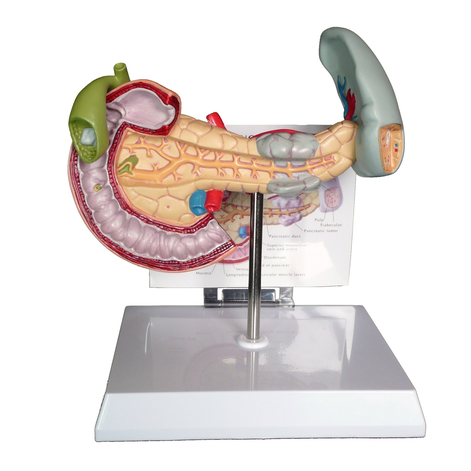 Anatomical Human Pancreas Spleen And Gallbladder Pathological Diseases