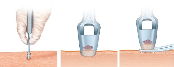 How And Why Is A Punch Biopsy Done Skin