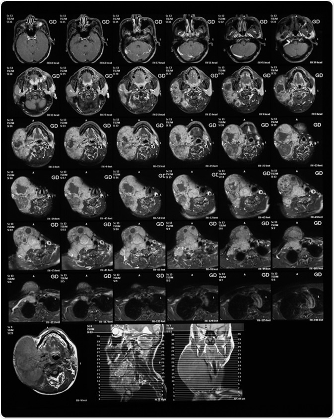 Gadolinium Mri