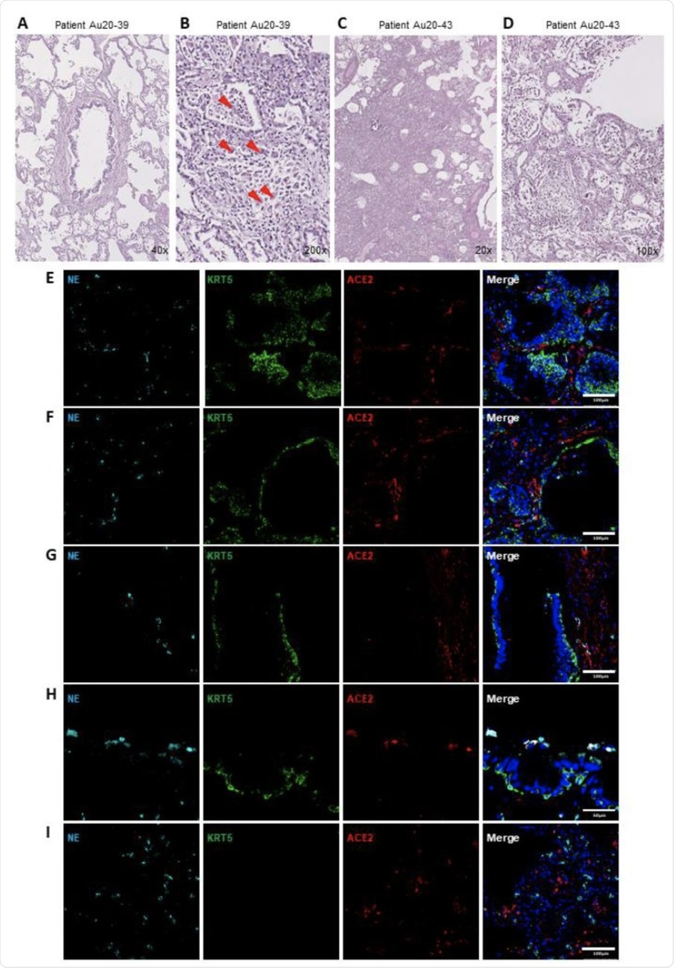 Role Of Neutrophil Epithelial Interactions In Sars Cov 2 Infection