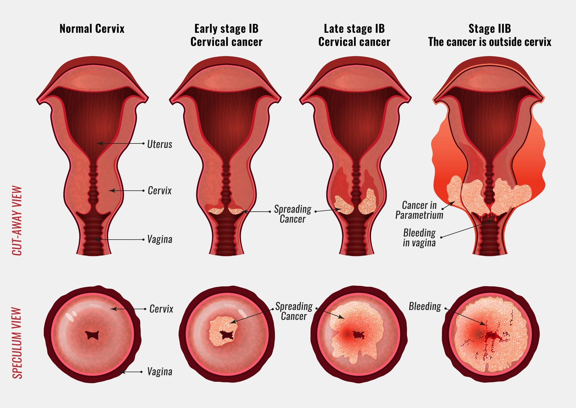 What Is Cervical Cancer