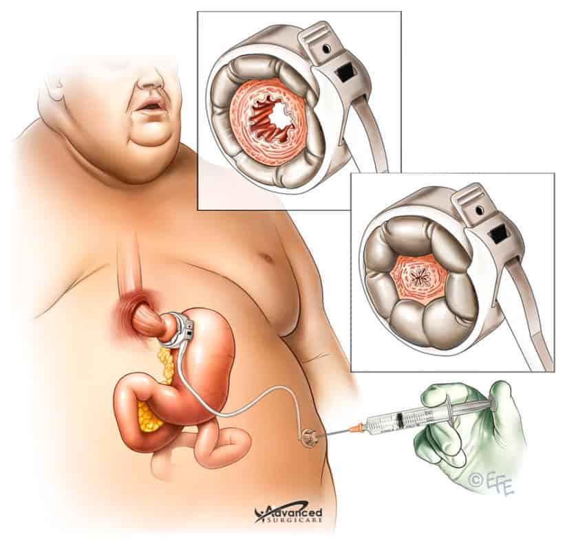 Lap Band Surgery Sydney Laparoscopic Adjustable Gastric Banding