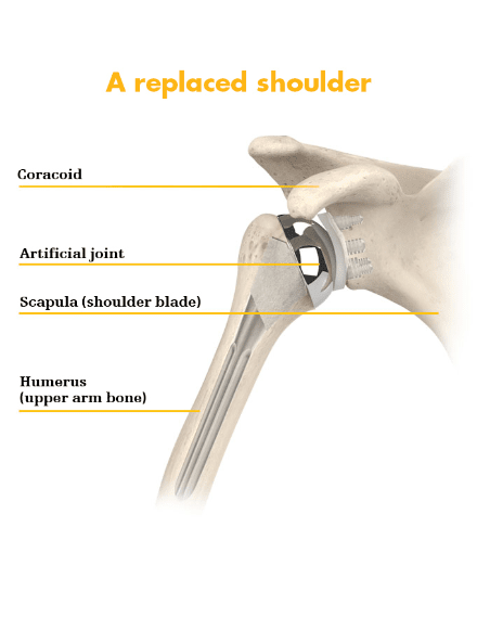 What Is Shoulder Replacement Stryker