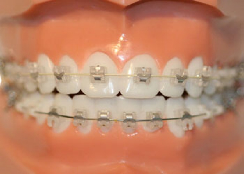 In Ovation Mini Metallic Braces Dr Aly Kanani Bc Orthodontist