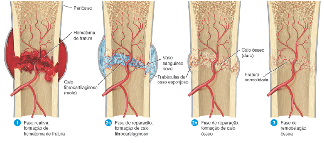 Fraturas Características E Primeiros Socorroscolunistas Sanar Medicina