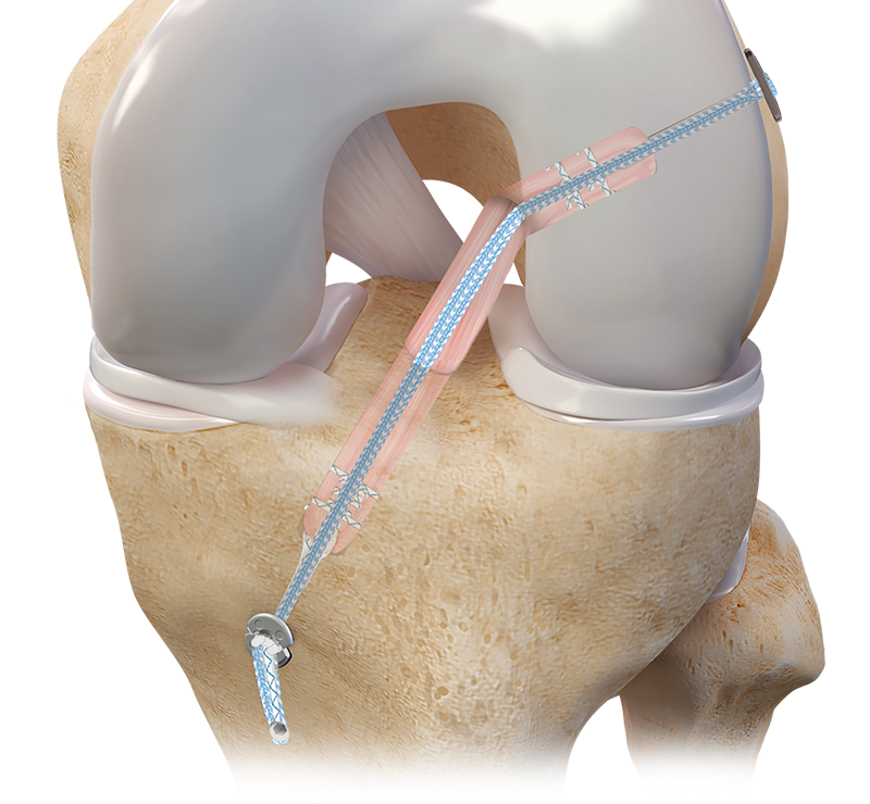 Arthrex Hamstring Autograft Acl Reconstruction