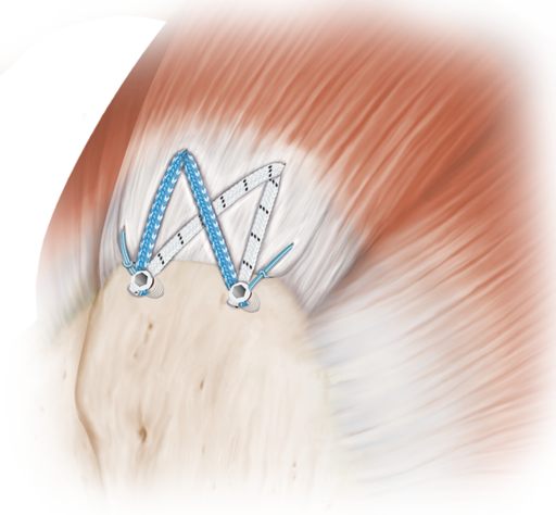 Arthrex Speedbridge™ Rotator Cuff Repair