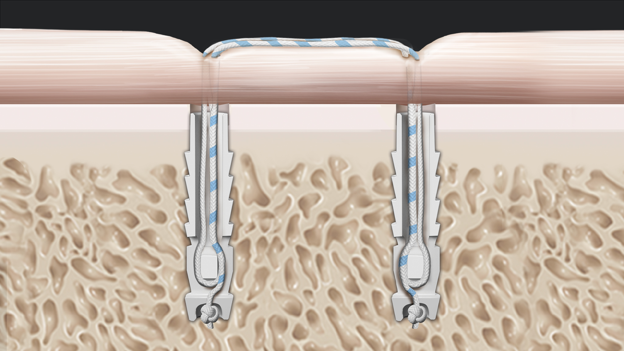 Arthrex Bony Bankart Repair Using Tensionable Knotless Technology