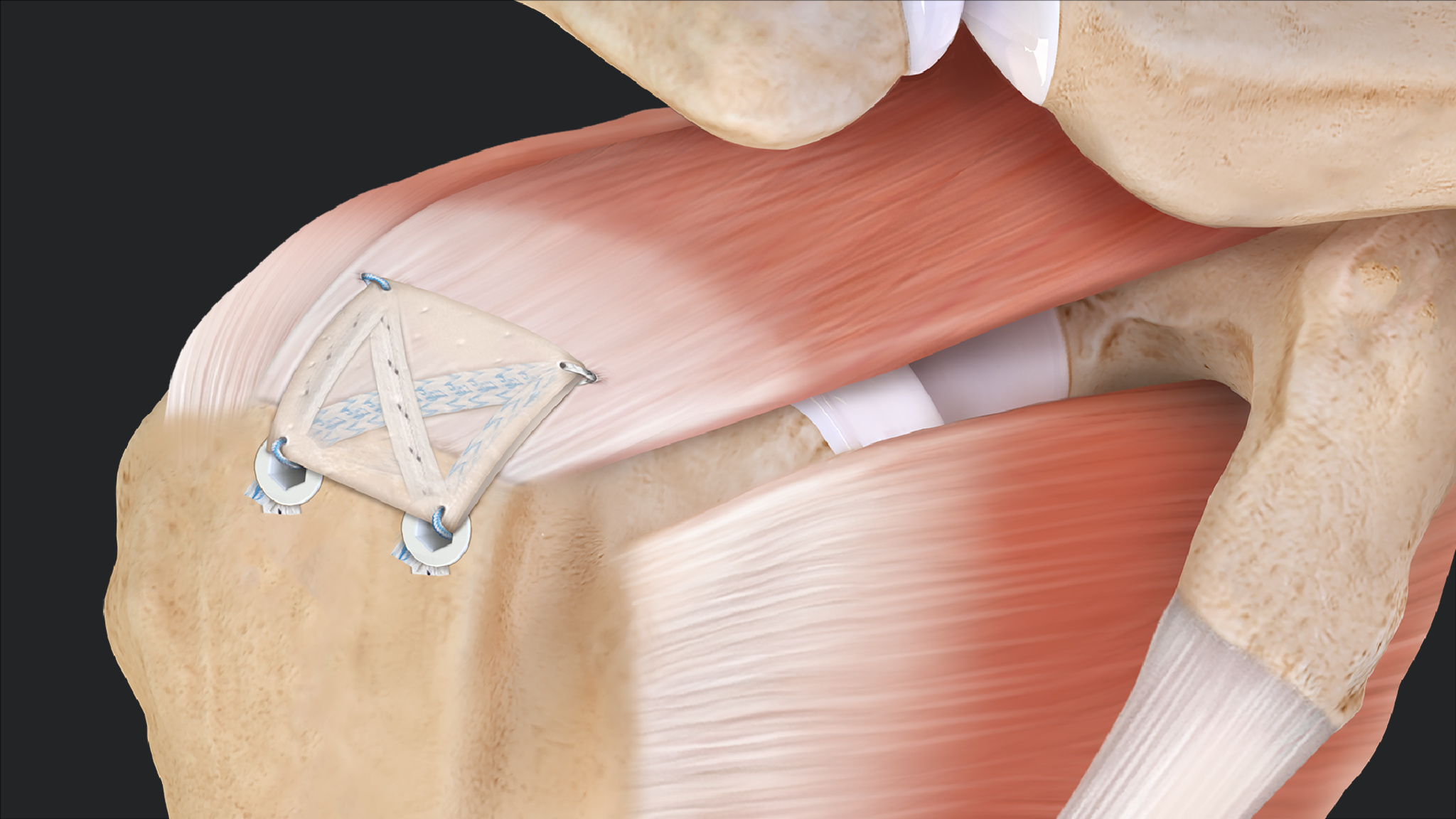 Arthrex Speedbridge™ Canopy Augmentation Technique With Arthroflex