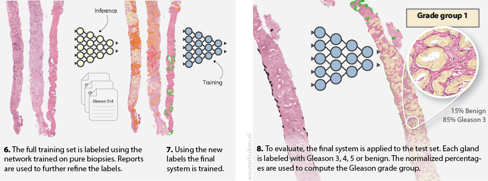 Pathologist Level Gleason Grading Using Artificial Intelligence Ai