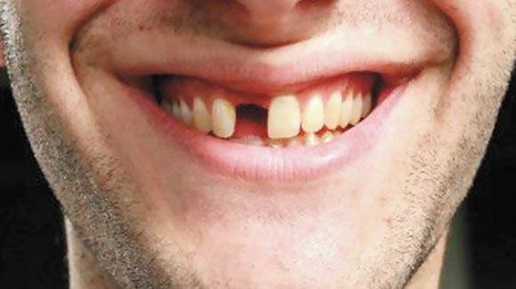 Perda De Dentes E Suas Consequências Md Odontologia