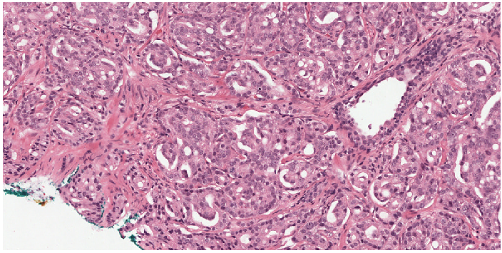 Pathologist Level Gleason Grading Using Artificial Intelligence Ai