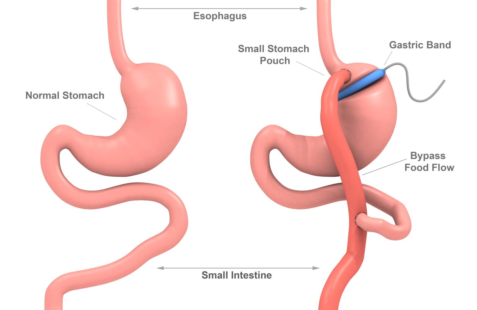 Gastric Banding Lap Band Surgery How Its Done Risks What To Expect