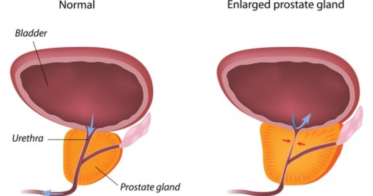 Transurethral Resection Of The Prostate Turp Procedure