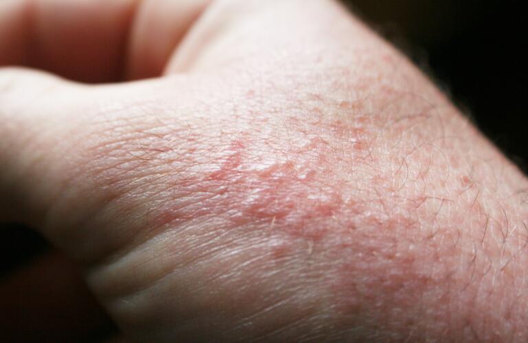 Poison Oak Rash Symptoms Treatment And Pictures