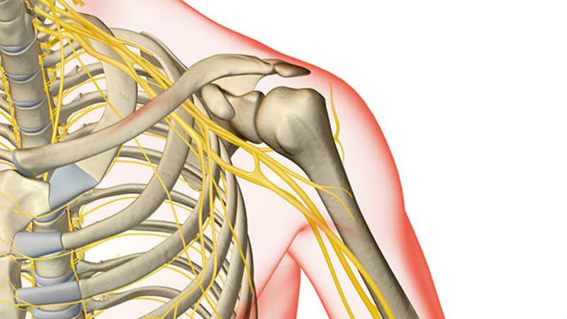 Brachial Plexus Injury Adult