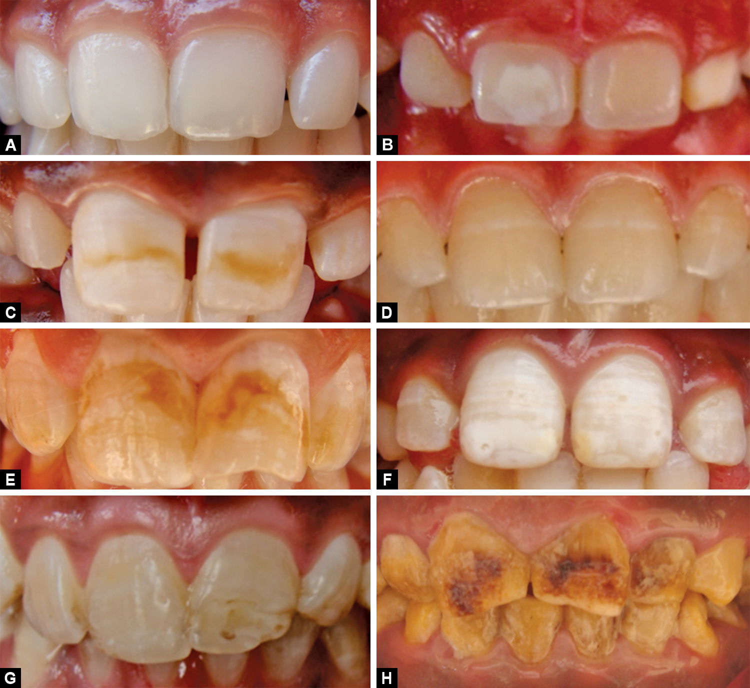 Study Of Developmental Defects Of Enamel In Young Permanent Maxillary