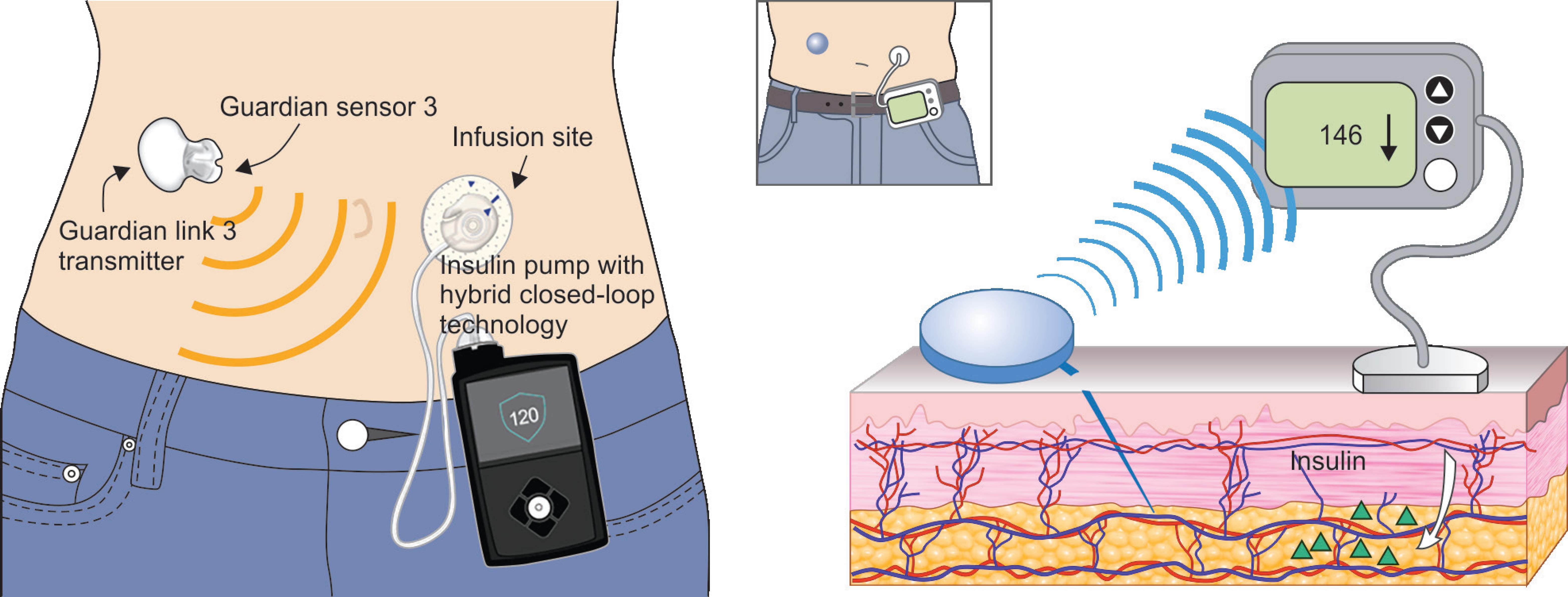 Closed Loop Insulin Pump Systems