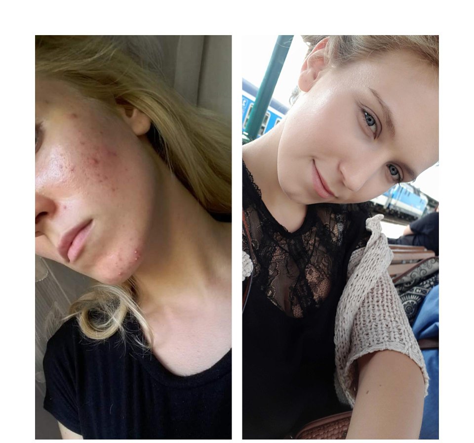 Accutane Before And After Newbeauty